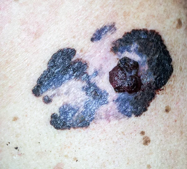 Melanoma Stockfoto's, Rechtenvrije Melanoma afbeeldingen | Depositphotos®