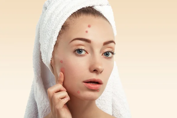 female with problem skin - Stock Image - Everypixel