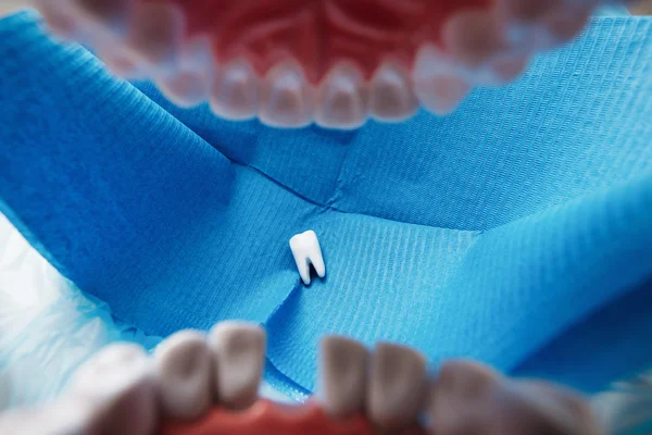 Tooth fell out at dentist office. Point of view of the patient. - Stock ...