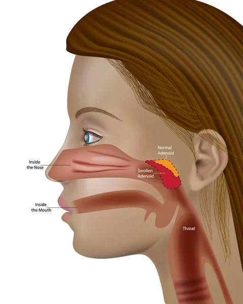 Adenoid Nose