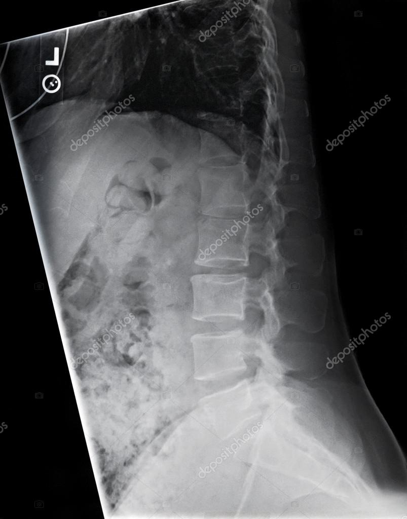 Lateral Coccyx Xray