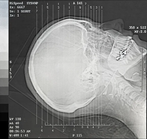 CT Scan Scout Stock Photo by ©Lawcain 68643537