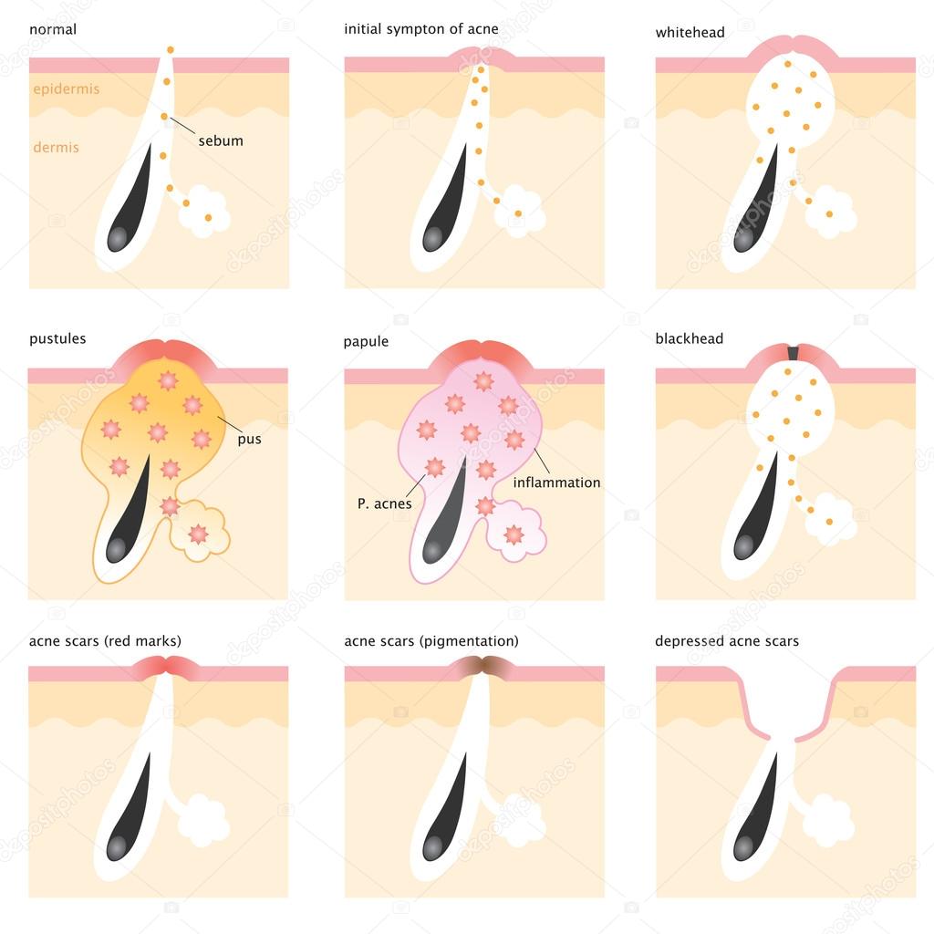 Acne formation process — Stock Photo © mug5 #83086184