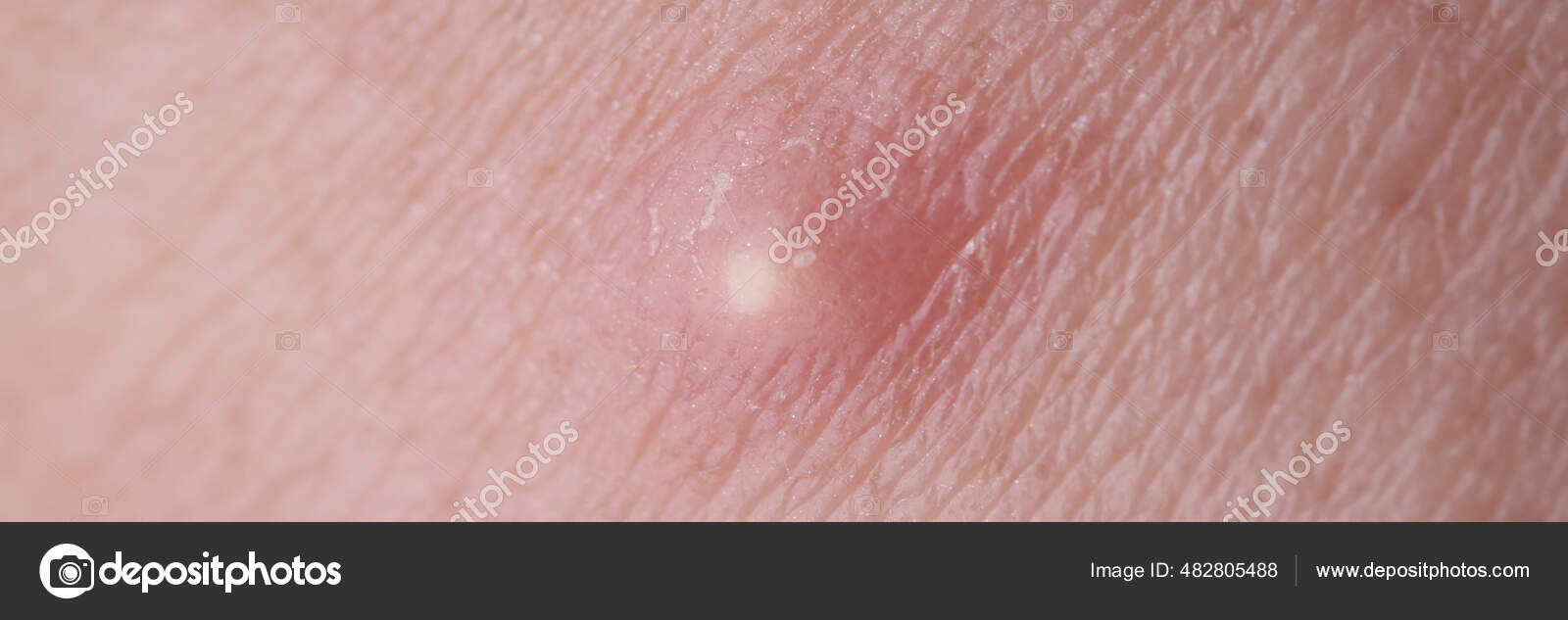 Espinilla con secreción purulenta en el primer plano de la piel — Foto ...