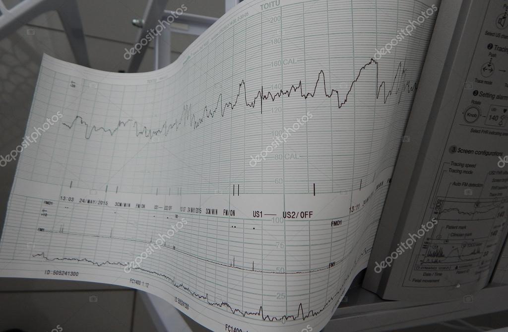 Cardiograph fixing and printing graphs of heart rate — Stock Photo ...