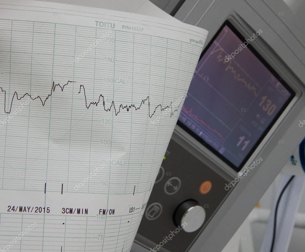 Cardiograph fixing and printing graphs of heart rate — Stock Photo ...