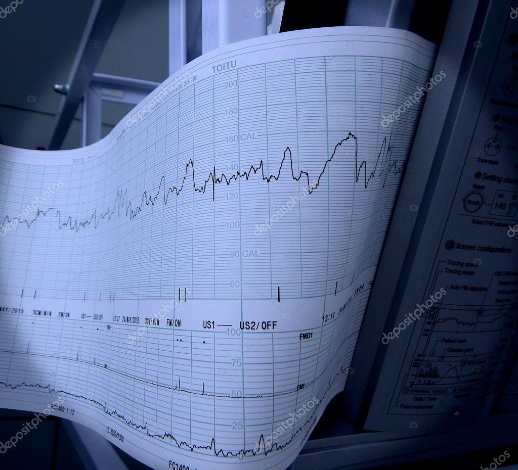 Cardiograph fixing and printing graphs of heart rate — Stock Photo ...