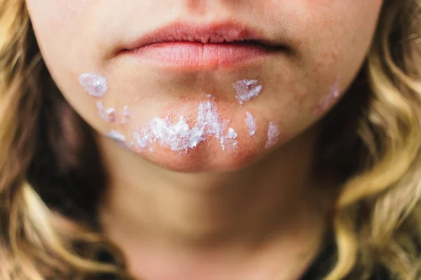 Rash on beard Pictures, Rash on beard Stock Photos & Images ...