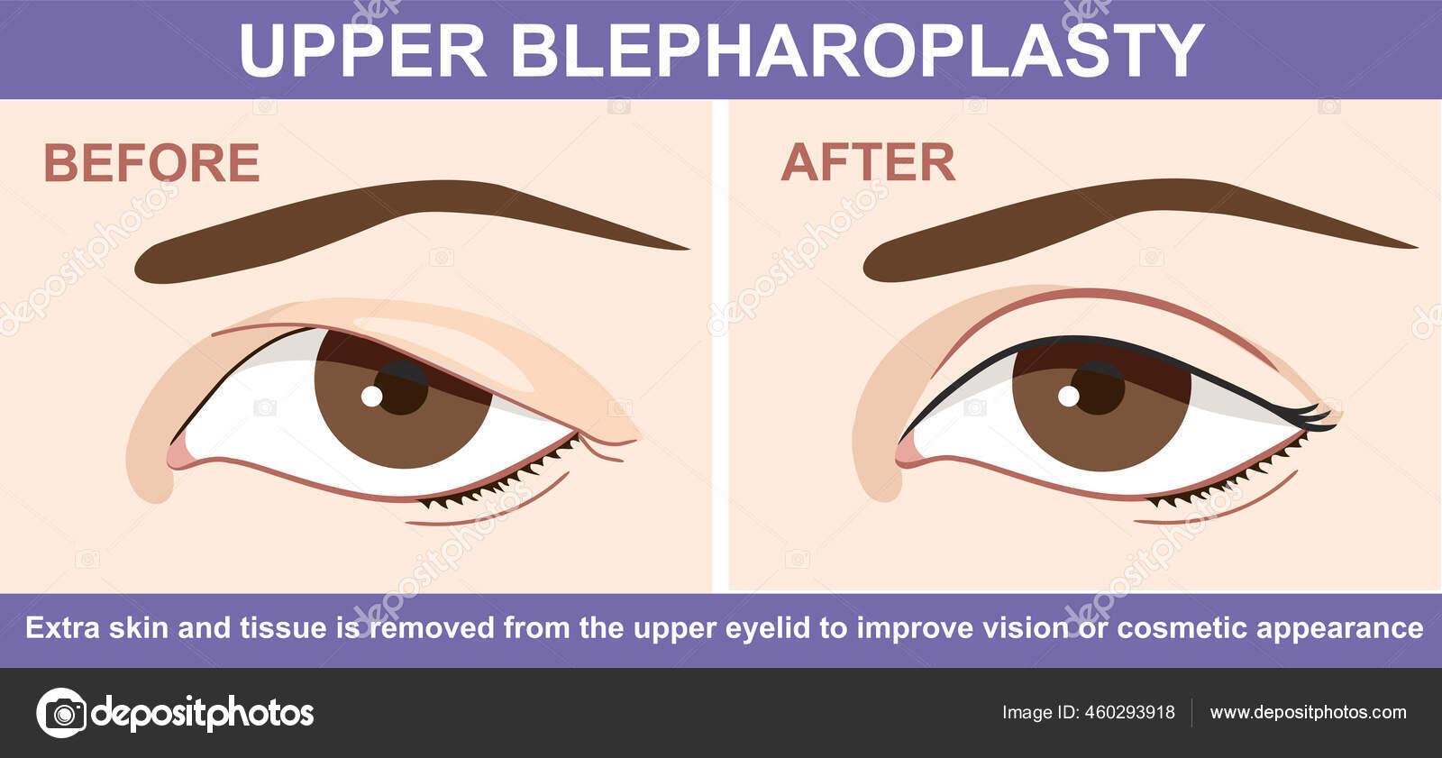 Blepharoplasty of eyelid , before and after. Vector illustration with ...