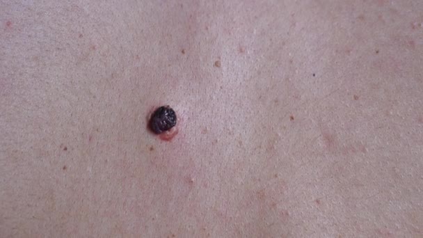 Mole Treatment Cryotherapy Dying Seborrheic Keratosis Macro Close ...