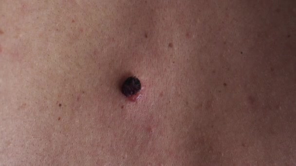 Mole Treatment Cryotherapy Dying Seborrheic Keratosis Macro Close ...