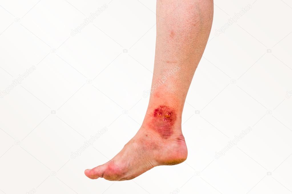 Red rash on leg of patient who was bitten by an insect Stock Photo by ...