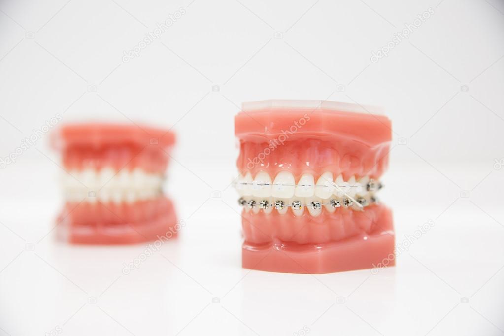 Model of human jaw with wire braces — Stock Photo © zlikovec #78424080