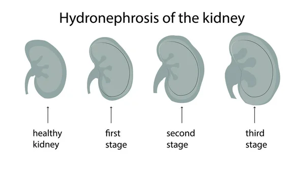 34 Hydronephrosis Vector Images, Hydronephrosis Illustrations ...