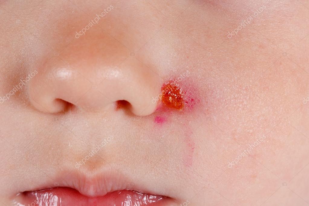 Treatment and prevention of insect bites Stock Photo by ©BravissimoS ...