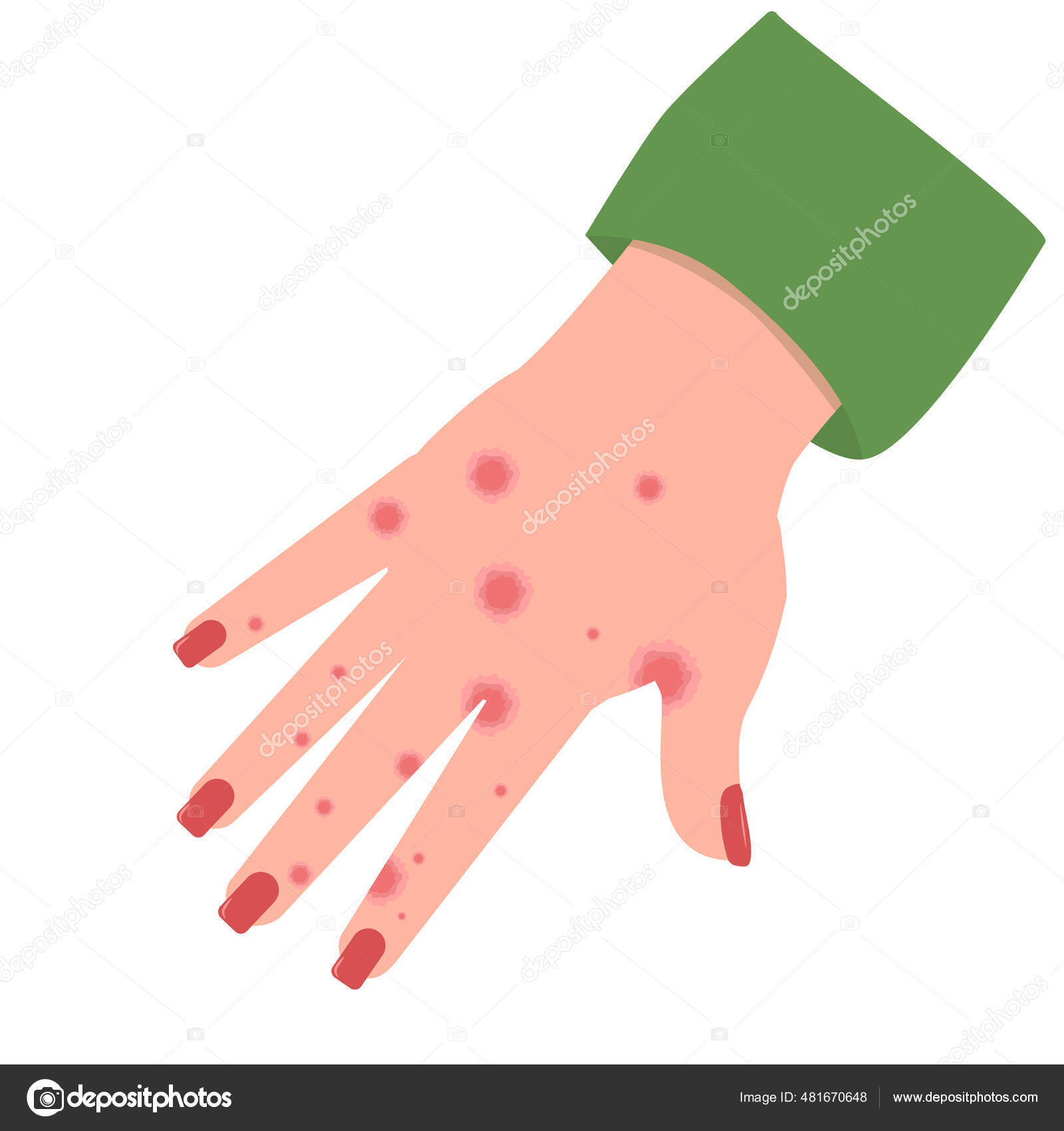 Ilustración Vectorial Una Mano Con Manchas Eccema Dermatitis Contacto ...