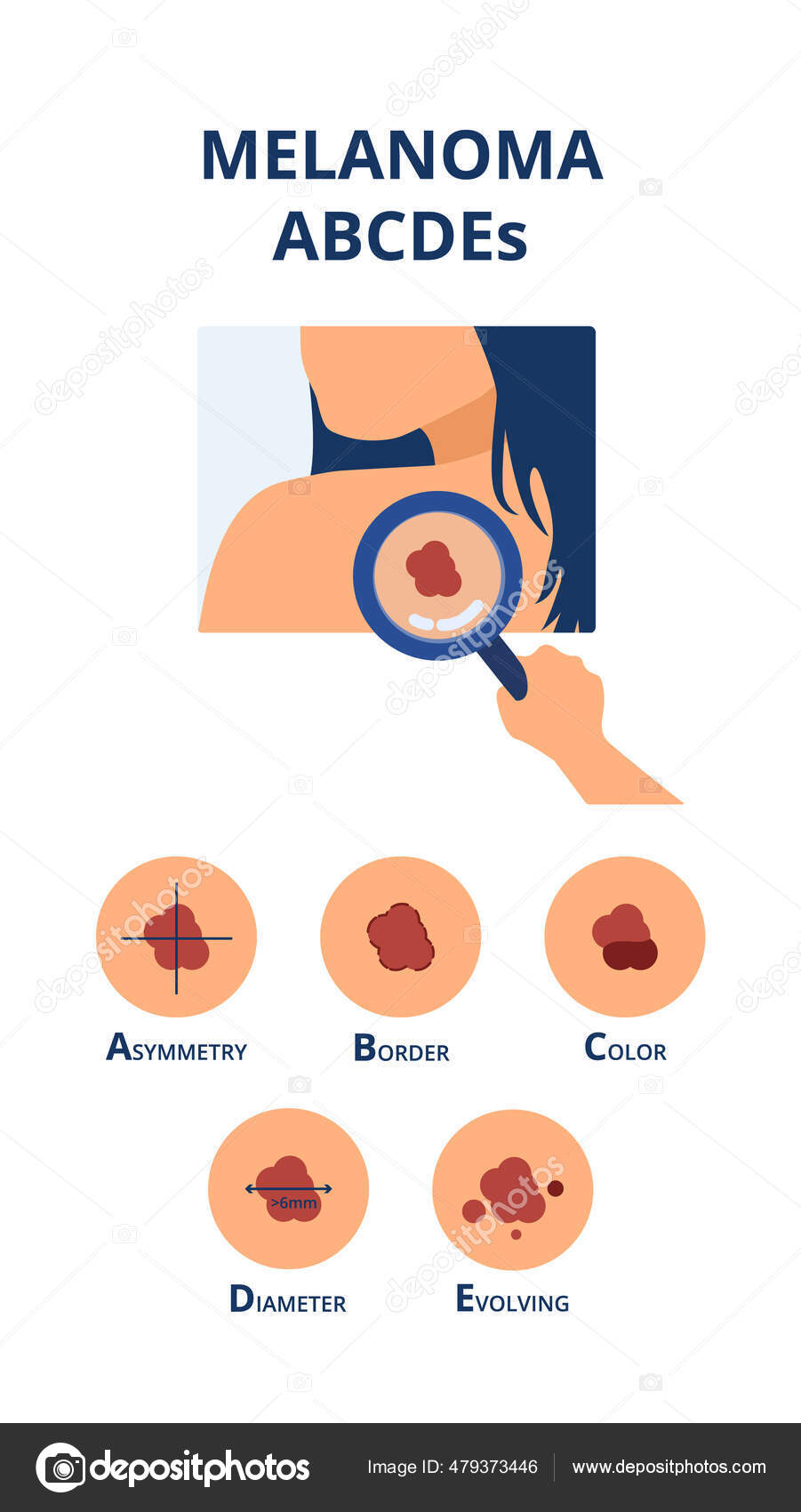 Melanoma Abcdes Symptoms Big Diameter Asymmetry Uneven Color Uneven ...
