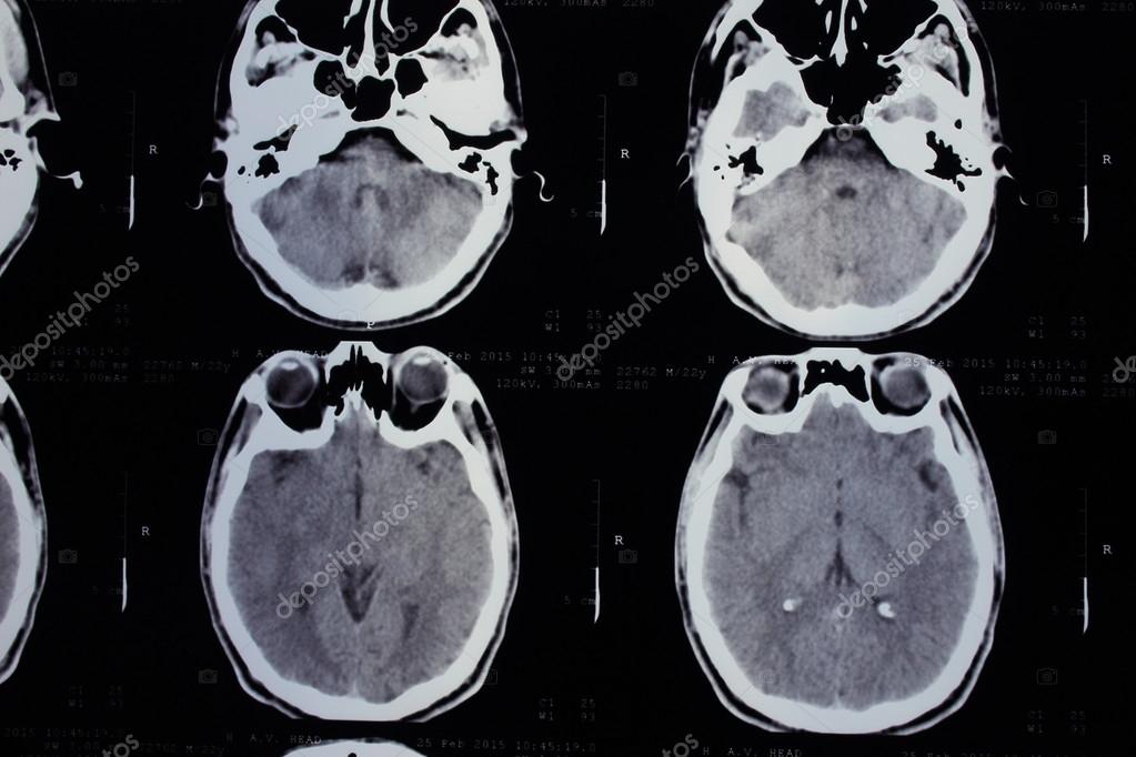 CT-scan van het hoofd ⬇ Stockfoto, rechtenvrije foto door © sandro ...