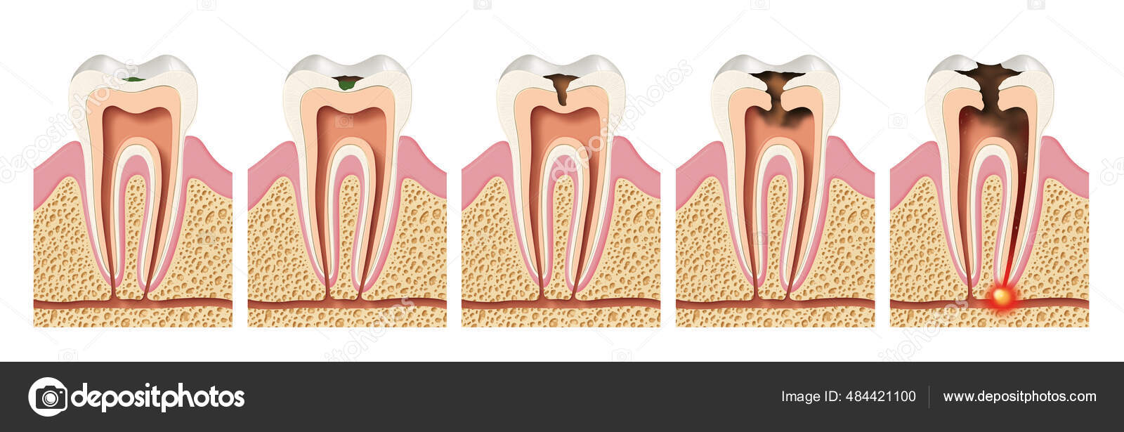 Dental Caries Progression