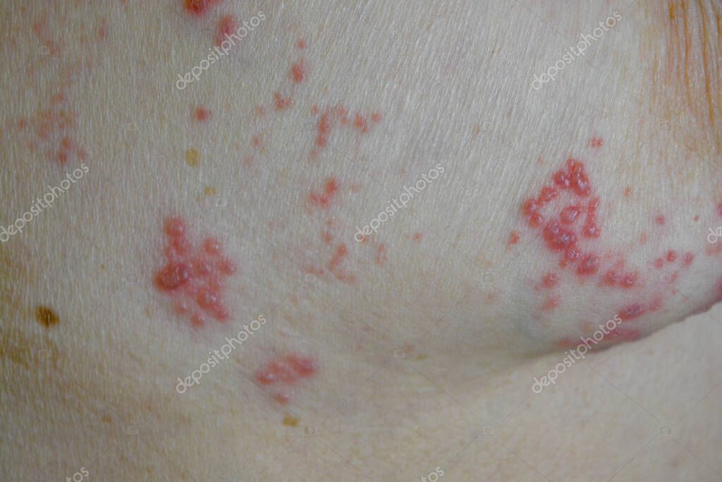 Sarpullido de culebrilla. Sarpullido vesicular del virus varicela ...