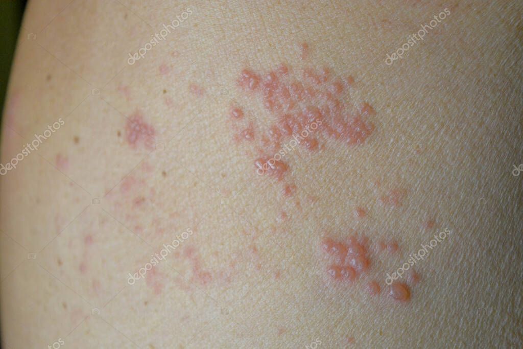 Culebrilla. Sarpullido cutáneo papular del virus varicela zoster en el ...