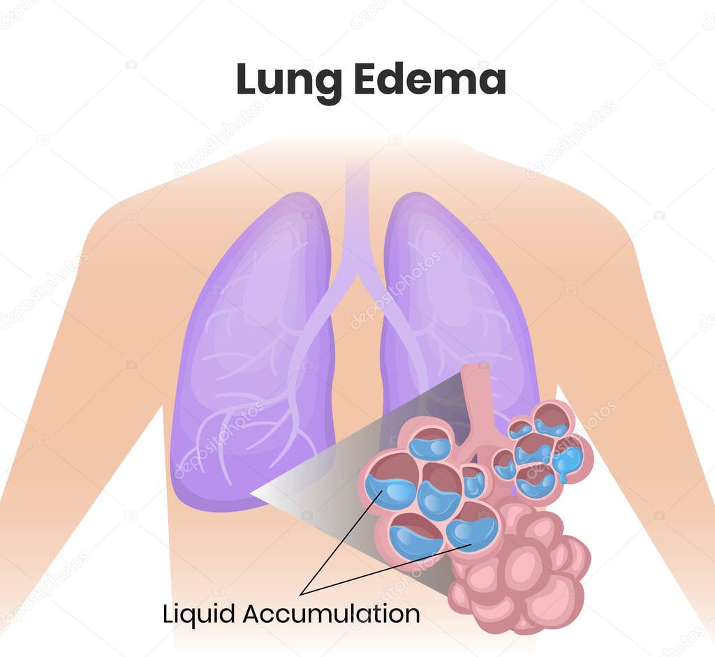 Edema pulmonar. Ilustración de los pulmones humanos con un primer plano ...
