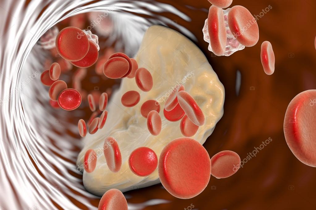 Placa de ateroma dentro de la arteria 2024