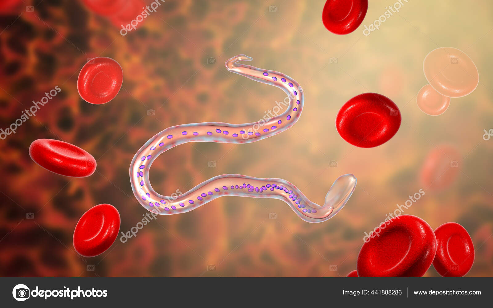 Lymphatic Filariasis Worm