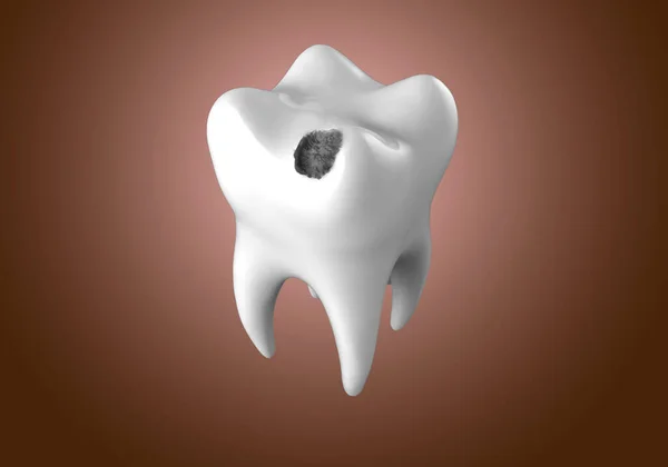 Human tooth with black hole. Dental caries, 3D illustration - Stock ...