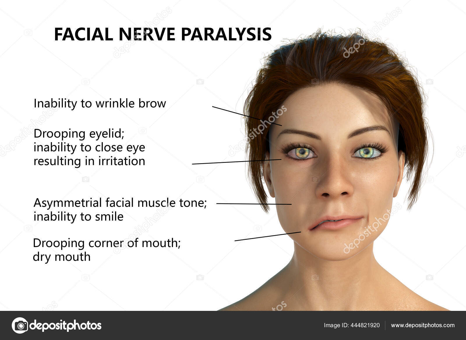 Facial Nerve Paralysis Bell's Palsy Illustration Showing Female One ... Facial Nerve Paralysis Bell's Palsy Illustration Showing Female One ...