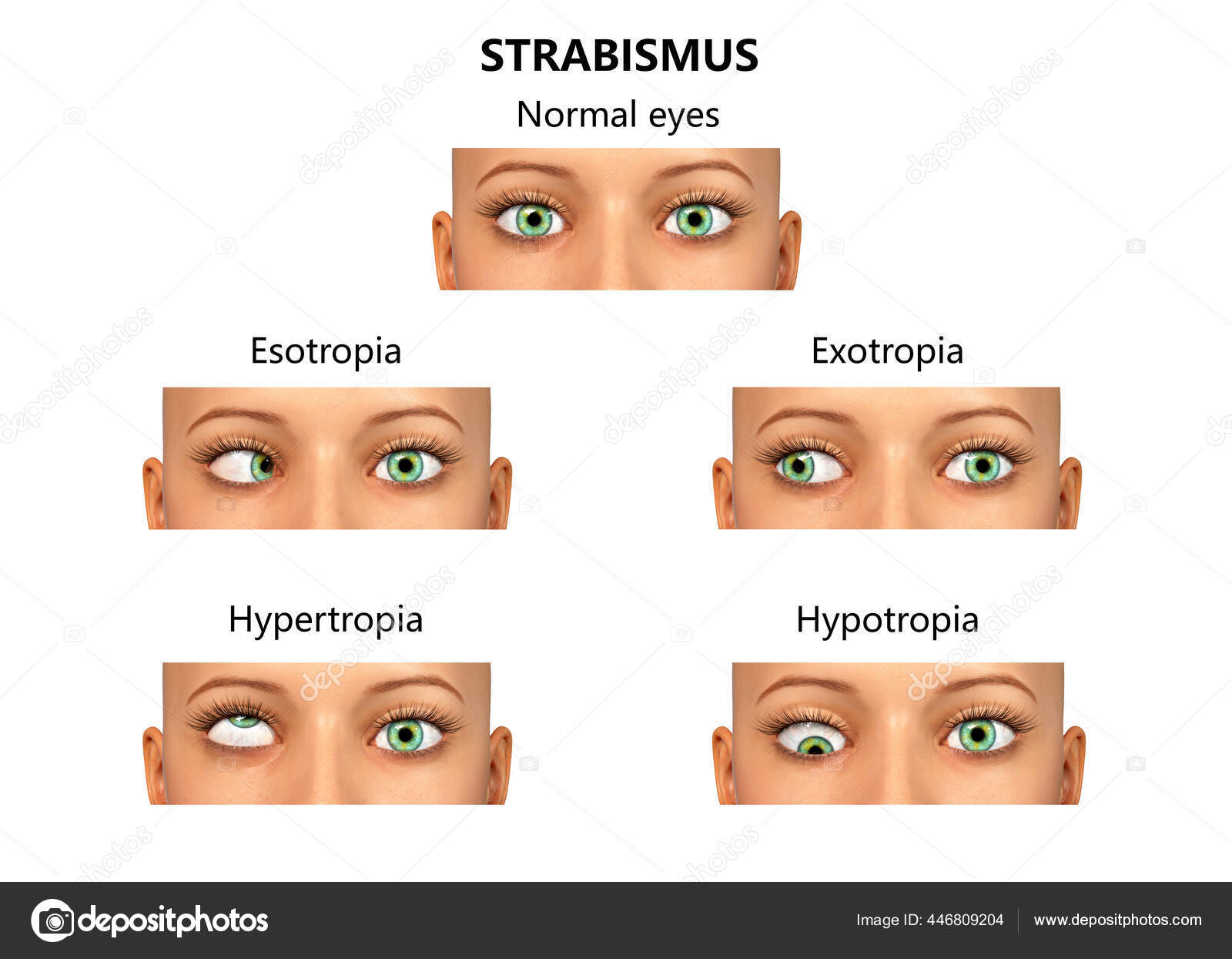 Strabismus Illustration Showing Different Types Eye Deviations Stock ...