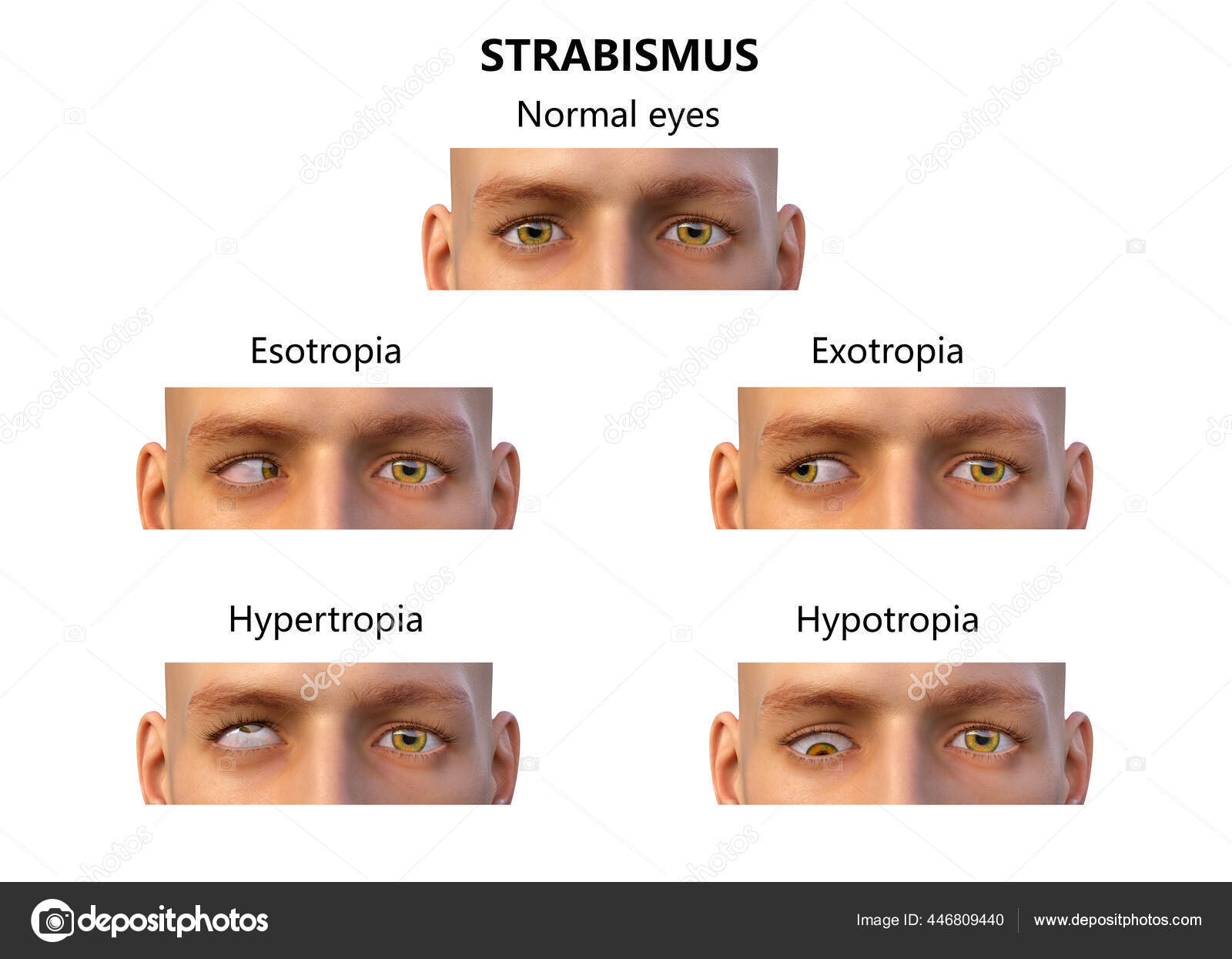 Strabismus Illustration Showing Different Types Eye Deviations Stock ...