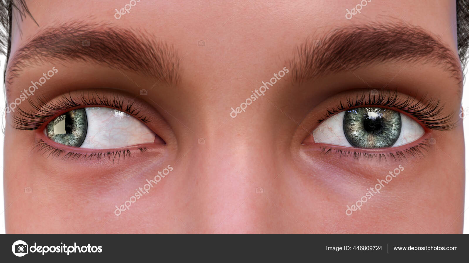 Strabismus Illustration Showing Exotropia Type Eye Deviation Eye Turns ...