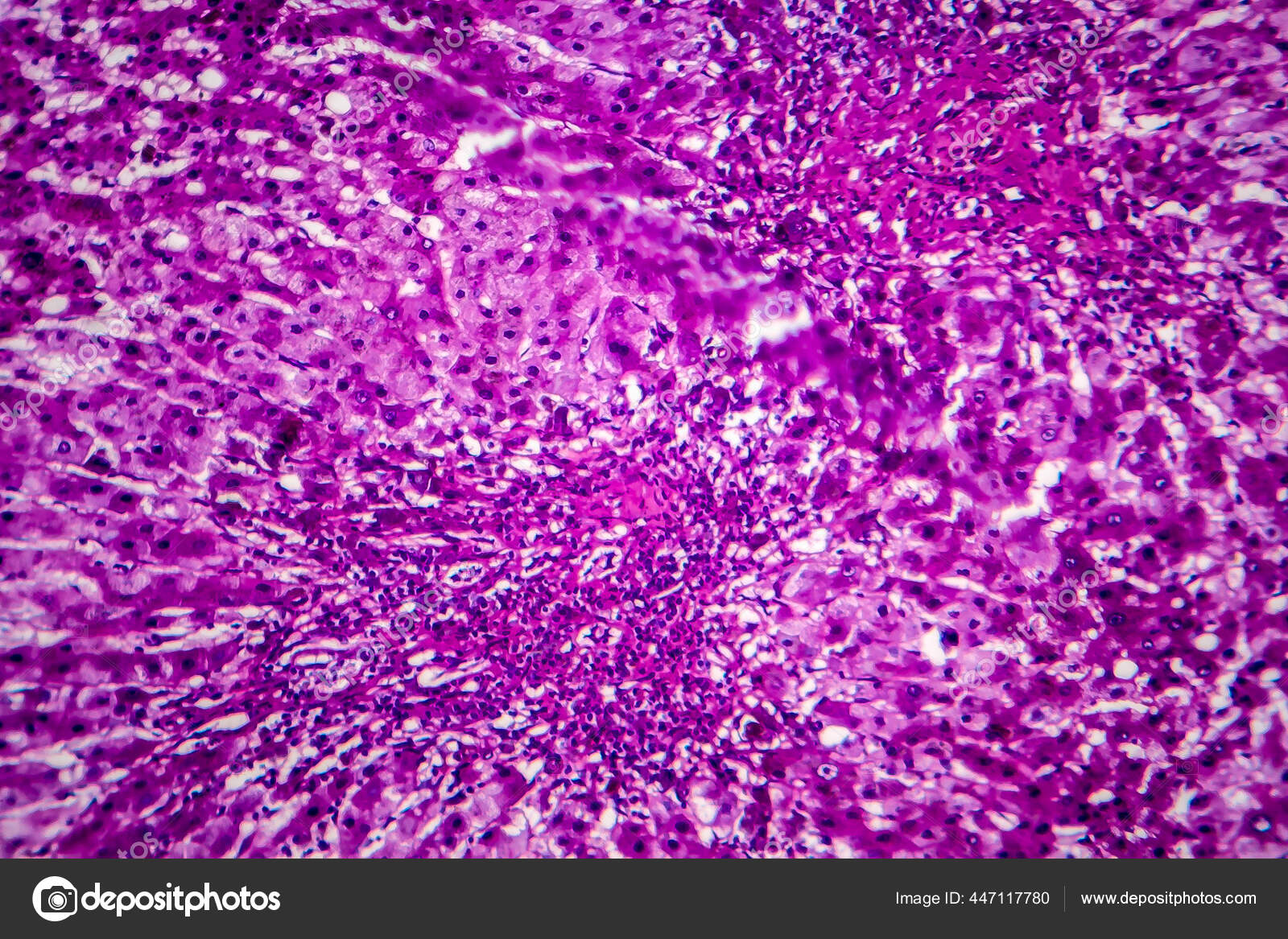 Histopathology Alcoholic Hepatitis Light Micrograph Photo Microscope ...