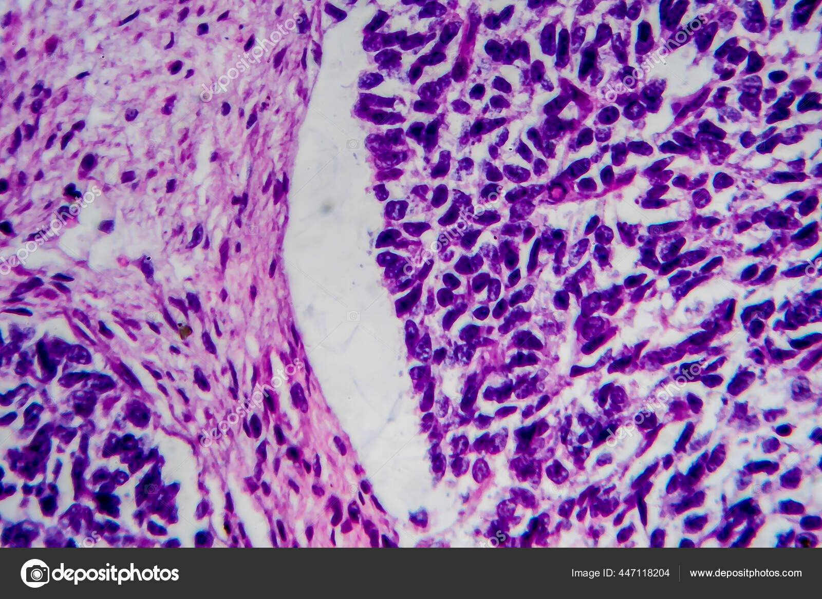 Tumor Wilms Nefroblastoma Micrografía Ligera Foto Bajo Microscopio ...