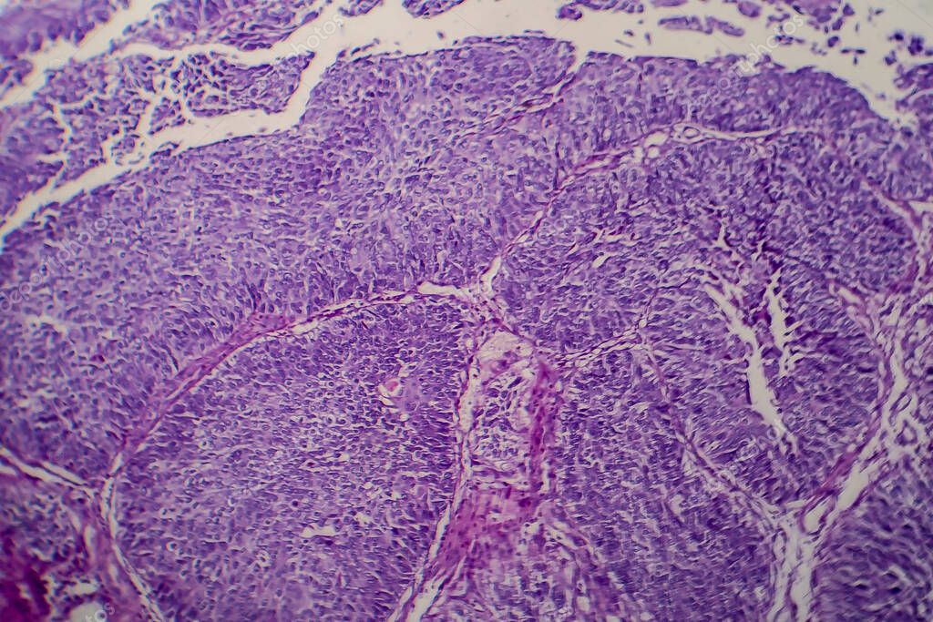 Carcinoma de c lulas de transici n vesical, micrograf a ligera, foto ...