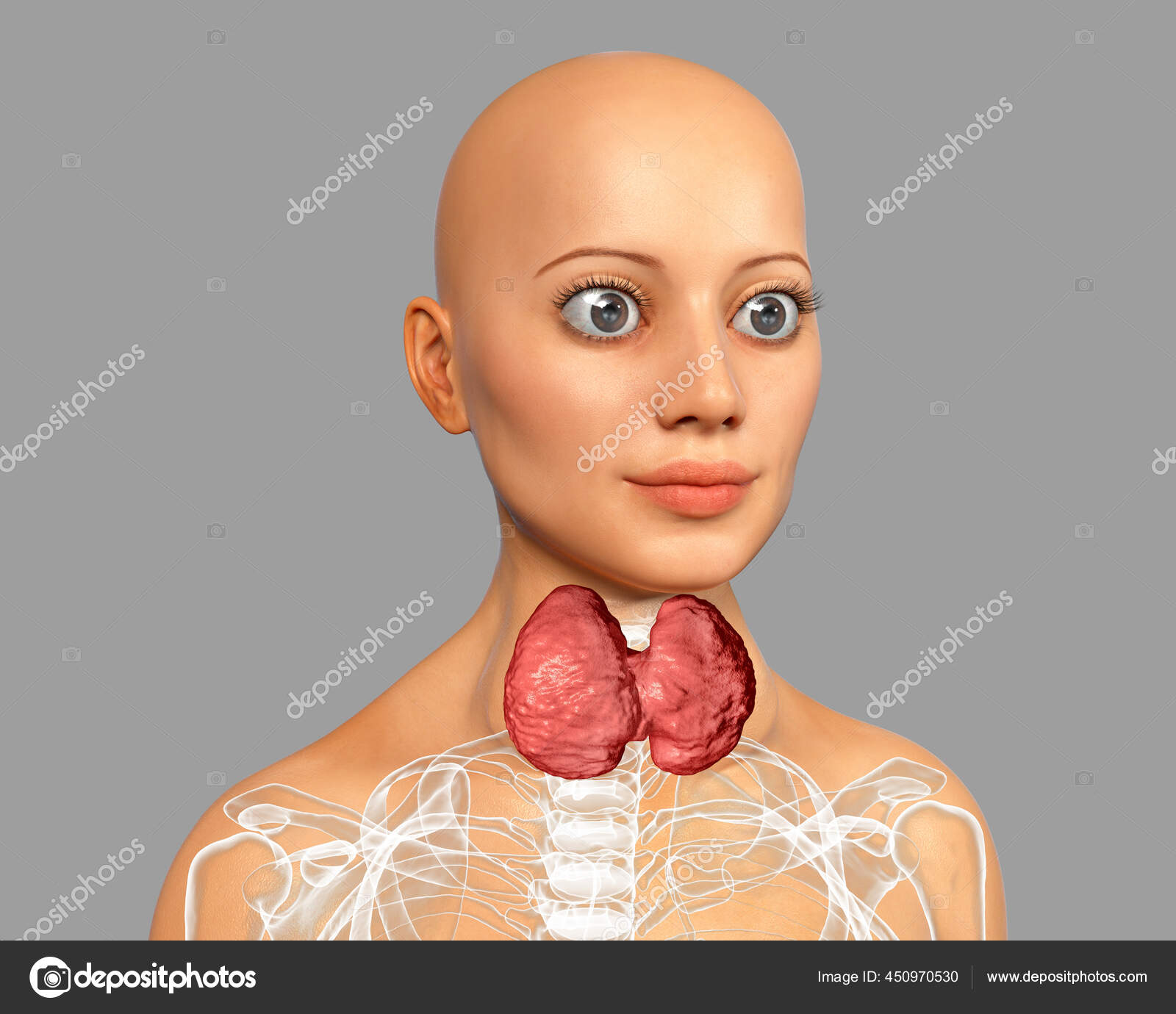 Hyperthyroidism Illustration Showing Enlarged Thyroid Gland ...