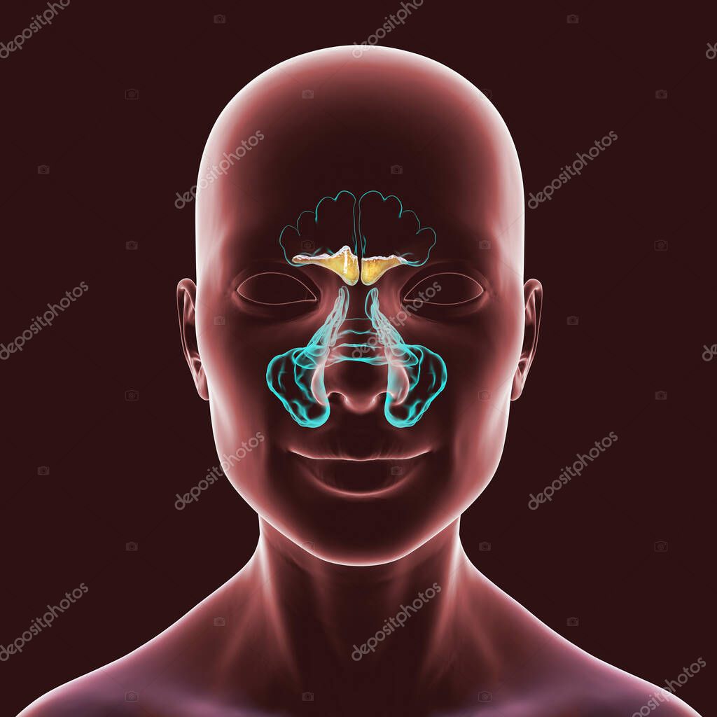Sinusitis, inflamación de las cavidades paranasales. Ilustración 3D que ...
