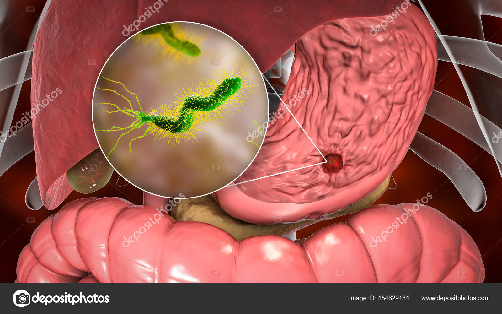 Stomach Ulcer Closeup View Bacteria Helicobacter Pylori Associated ...