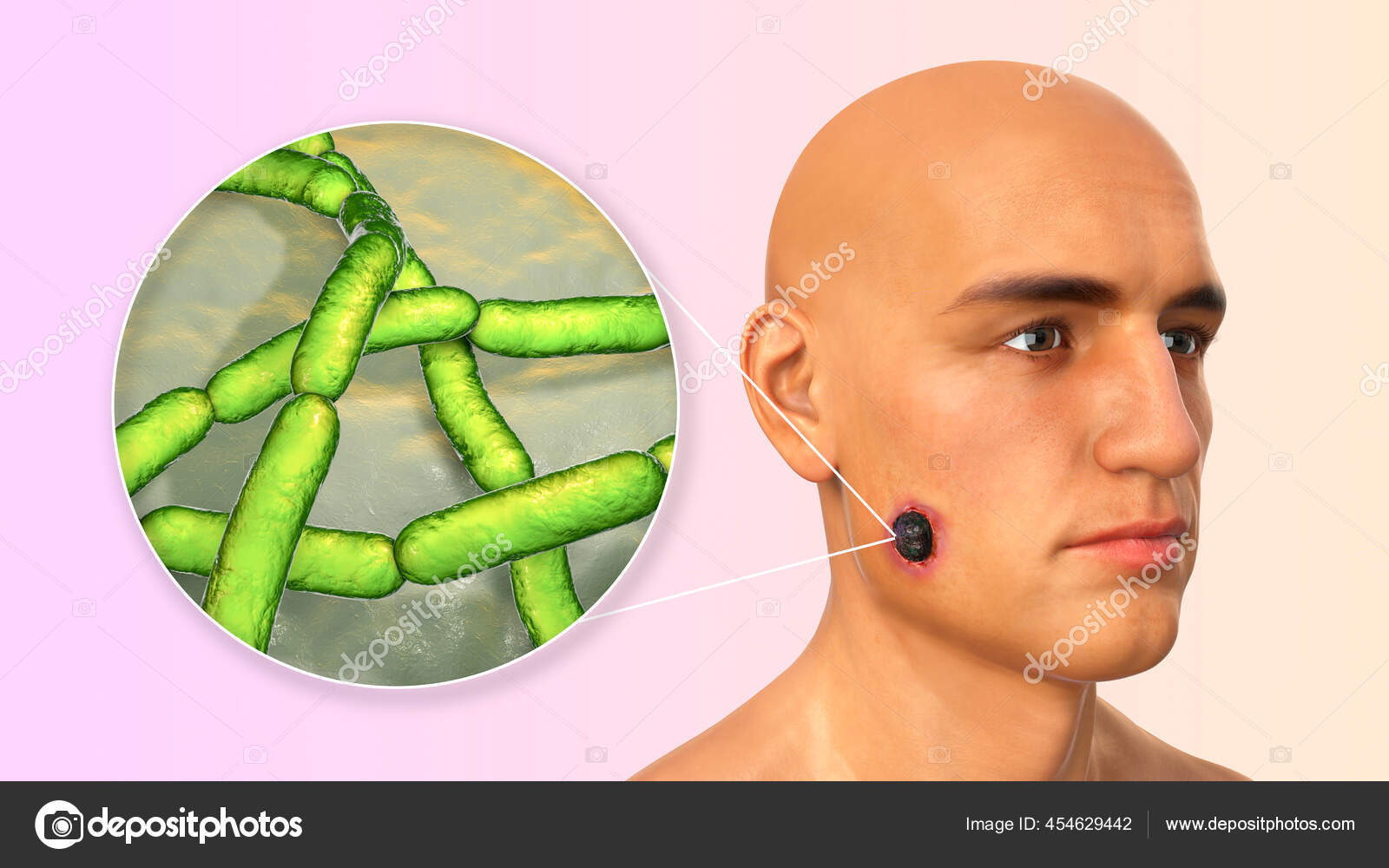 Cutaneous Anthrax Most Common Form Anthrax Illustration Showing ...