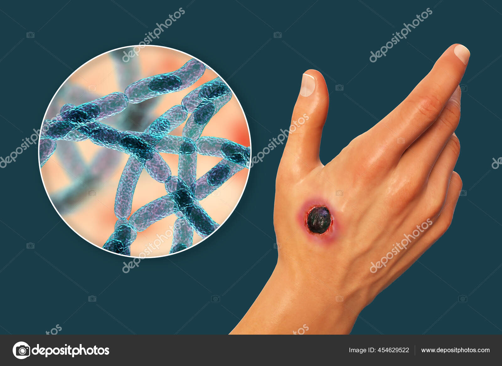 Cutaneous Anthrax Most Common Form Anthrax Illustration Showing ...