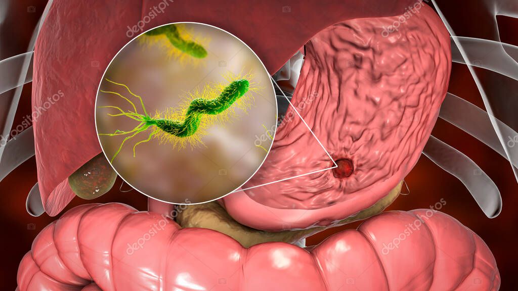 Úlcera de estómago y vista de cerca de las bacterias Helicobacter pylori, asociado con la ...