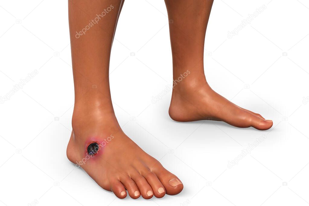 Ántrax cutáneo, la forma más común de infección causada por bacterias ...