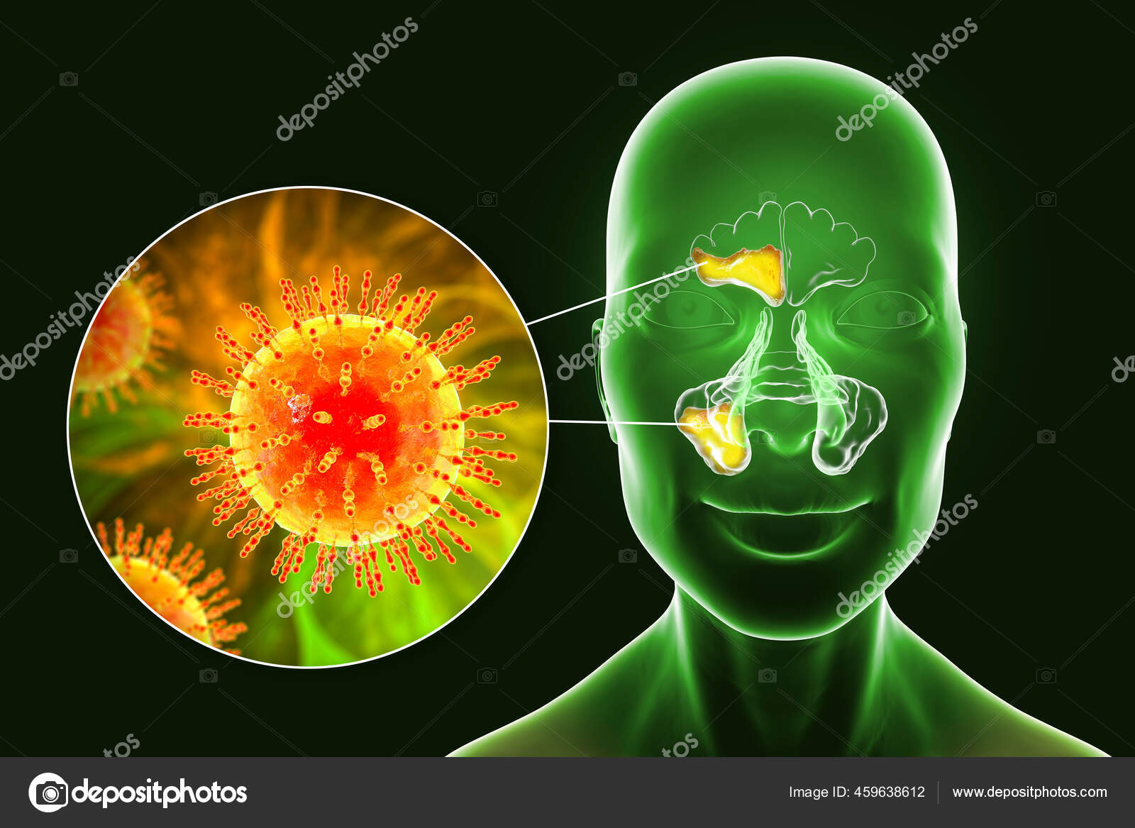 Viral Bihulebetændelse Betændelse Paranasale Hulrum Illustration Der ...