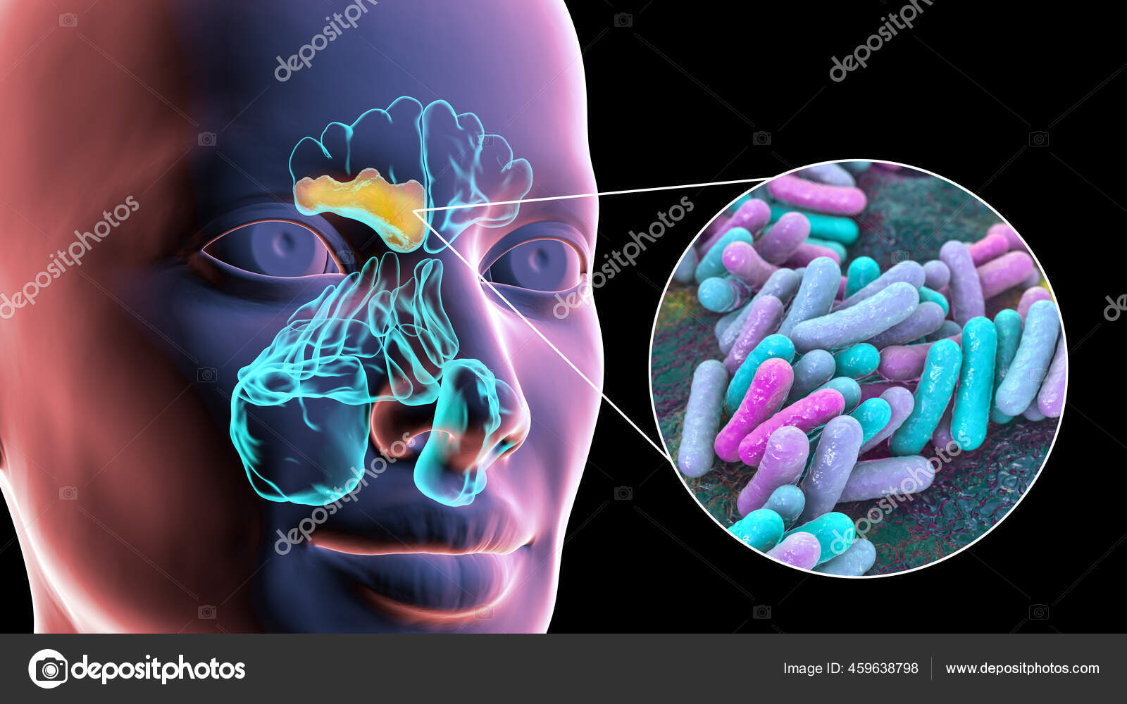 Sinuit Inflammation Paranasala Håligheter Illustration Visar Purulent ...
