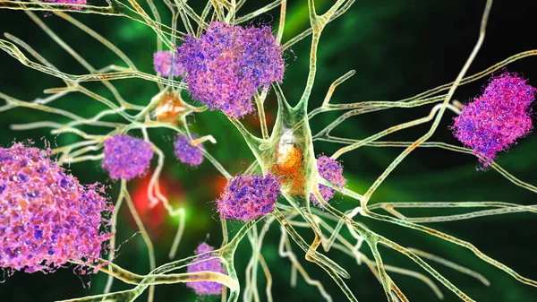 Neurons in Alzheimer's disease. 3D illustration showing amyloid plaques ...