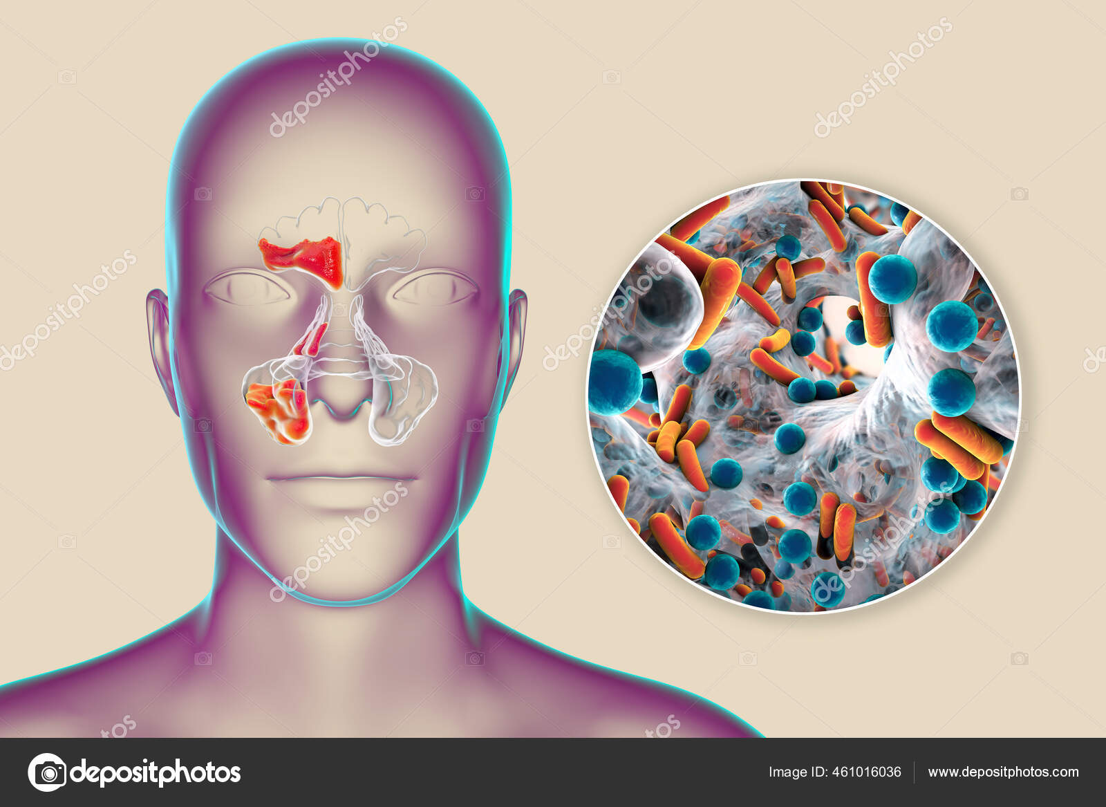 Sinusitis Inflammation Paranasal Cavities Illustration Showing Purulent ...