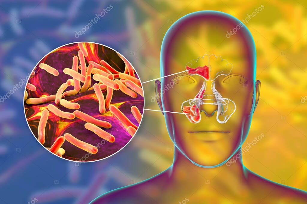 Sinusitis, inflamación de las cavidades paranasales. Ilustración 3D que ...