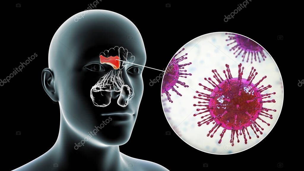Sinusitis viral, inflamación de las cavidades paranasales. Ilustración ...