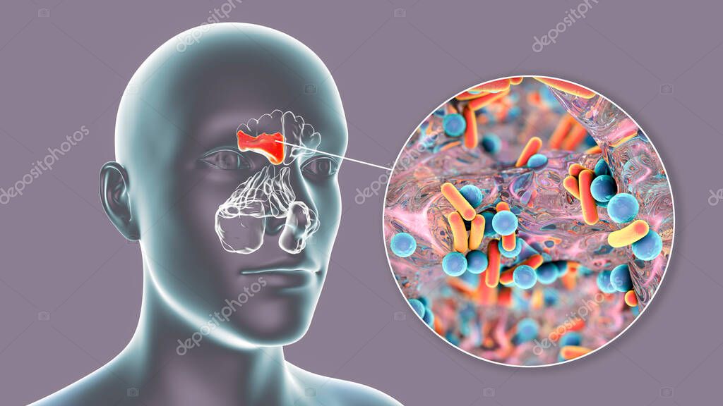 Sinusitis, inflamación de las cavidades paranasales. Ilustración 3D que ...